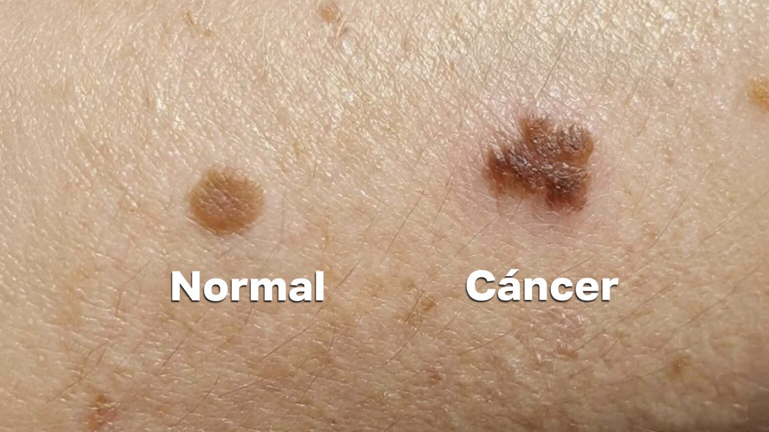 3 DIFERENCIAS ENTRE UN LUNAR NORMAL Y UNO QUE PODRÍA SER CÁNCER – Vertikal